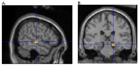 Figure 1 From Abnormalities Of Intrinsic Functional Connectivity In