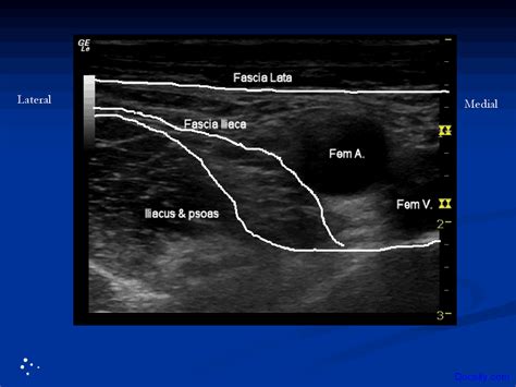 Ultrasound Guided Blocks Part 2 Anesthesia Lecture Slides Docsity