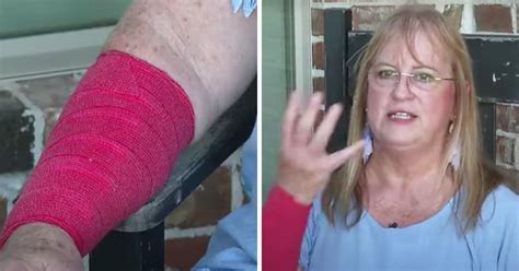 Woman Incurs Injuries After Snake Wraps Onto Her Arm Before Hawk Swoops