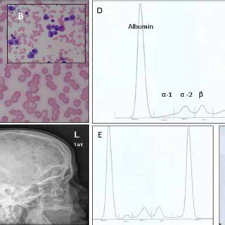 Some Of The Clinical Findings Seen In Patients With Multiple Myeloma Download Scientific