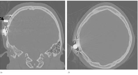 A B Patient 1 Ct Scan Of Cranium Magnet Rotation Is Visible Download Scientific Diagram