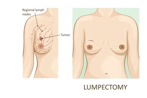 Breast Lumpectomy Neo