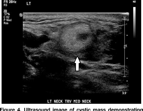 Branchial Cleft Cyst Ultrasound