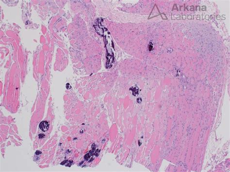 Calciphylaxis Neuro Notes Arkana Laboratories