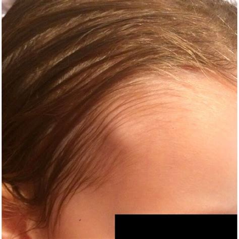 Subcutaneous Nodule On The Right Superolateral Forehead Download Scientific Diagram