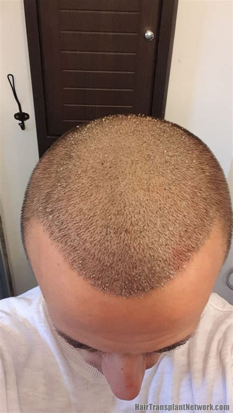 Hair Transplant Asmed Hair Restoration Network Community For And By