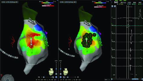 local activation time lat map of the same tachycardia during the