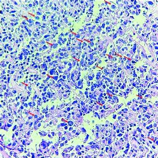 The Image Shows Diffuse Layers Of Large Cells That Destroy Or Replace Download Scientific