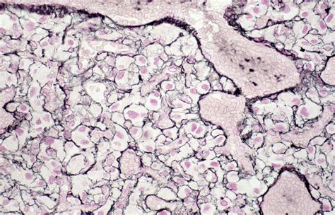 Haemangioblastoma Light Micrograph Stock Image C0603278 Science