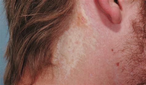 Linear Scleroderma Forehead