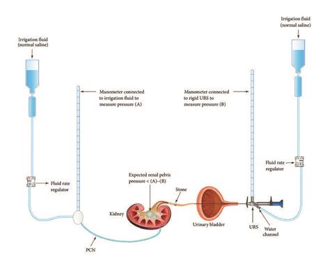 Pressure Drop Renal Pelvis Pressure Measurement During Ureteroscopic Download Scientific