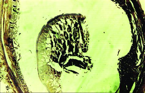 Cross Section Of Vermiform Appendix Having Ascaris Lumbrocoides In Download Scientific Diagram