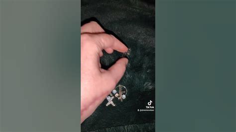 8 Weeks Post Cmc Joint Fusion Youtube