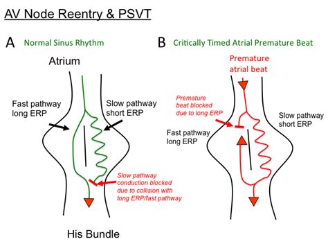 Cellularbasisforarrhythmias Tusom Pharmwiki