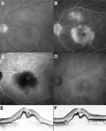 A 78 Year Old Man Was Treated With An Intravitreal Aflibercept Download Scientific Diagram