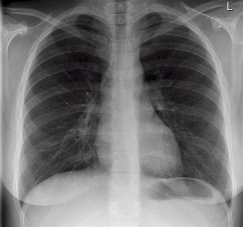 Reading The Chest X Ray Chest Radiography Identifying A Normal Chest
