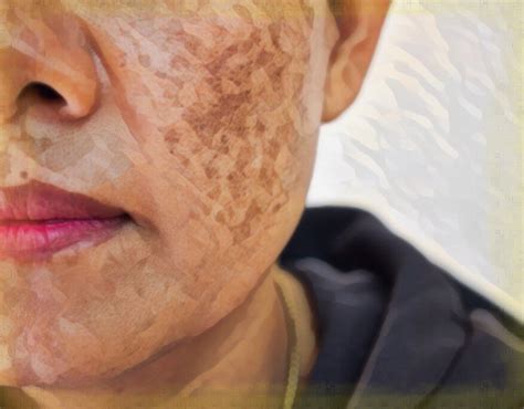 Пигментные пятна на лице как убрать в домашних условиях 5 способов