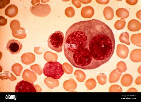 Acute Erythroid Leukaemia Light Micrograph Of Blood Cells From Bone