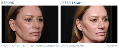 Exion Clear And Rf Microneedling San Diego