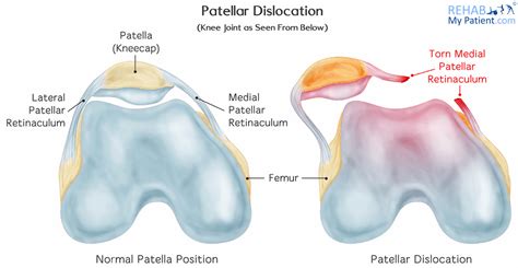 Patella Dislocation Manor View Practice