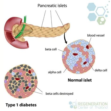 Type 1 Diabetes Diagram Pathophysiology Of Type 1 Diabetes And Gut