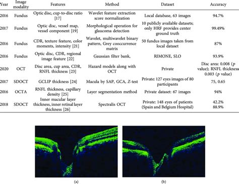 Review Of Oct And Fundus Imaging For Glaucoma Diagnosis Download