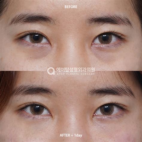 눈밑시술의 모든 것 시간이 갈수록 피부는 얇아지고 눈 밑은 꺼져 피곤해보이는 모습이 고민이신가요