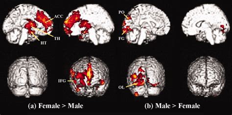 Gender Differences In The Older Group A Statistical Parametric Maps Download Scientific
