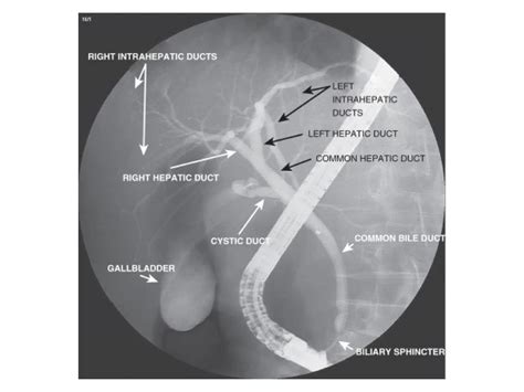 Endoscopic Retrograde Cholangiopancreatography Pptx