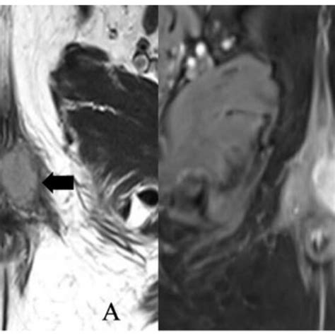 Revised 2021 Figo Staging Of Vulvar Cancer Stage I Tumor Confined To