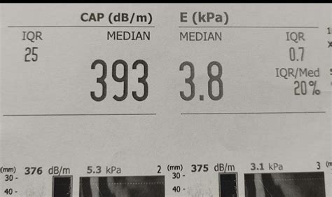 Fatty Liver I Had A Fibroscan British Liver Trust