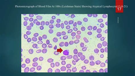 Atypical Lymphocytes Ppt