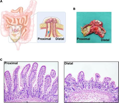 Loop Colostomy Reversal