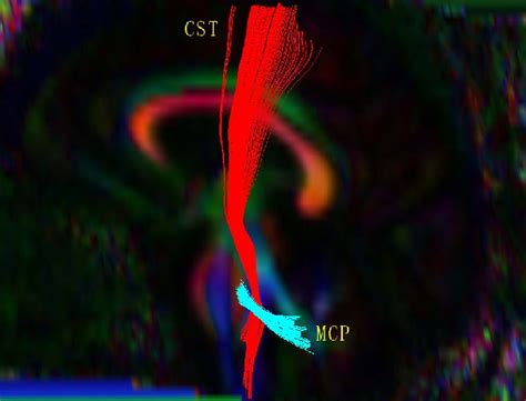 Figure 1 From Shape Modeling And Clustering Of White Matter Fiber Tracts Using Fourier