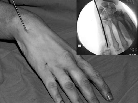 The Distal End Of K Wire Is Pulled Up To Metacarpal Head Download