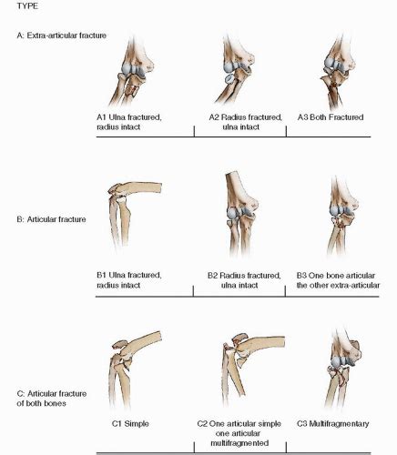 Olecranon Fractures Open Reduction And Internal Fixation Musculoskeletal Key