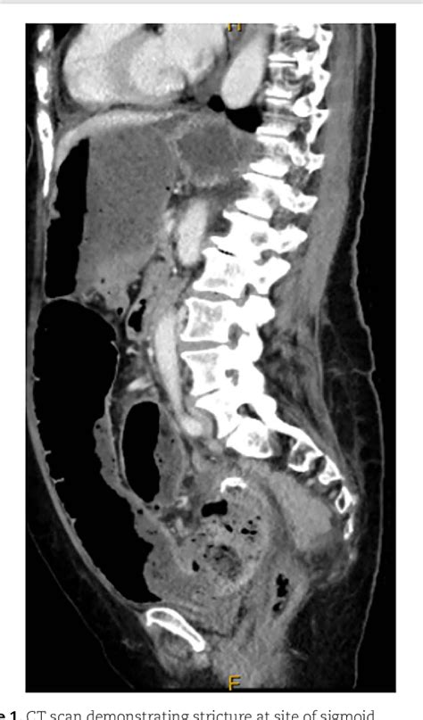[pdf] A Delayed Benign Anastomotic Stricture After Anterior Resection For Sigmoid Adenocarcinoma