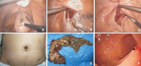 Laparoscopic Radical Right Hemicolectomy With Transrectal Specimen Extraction A Novel Natural