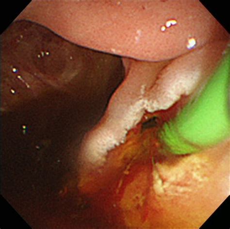 Can Endoscopic Stone Retraction Be Carried Out Even In Cases With Severe Acute Cholangitis