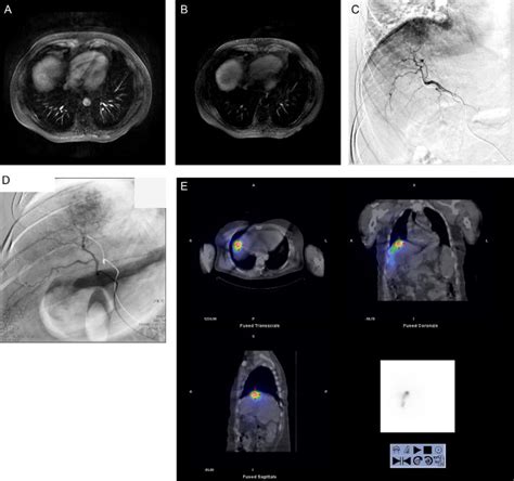 Radiation Segmentectomy And Radiation Lobectomy A Practical Review Of Techniques Techniques