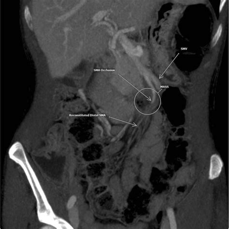 Egd Of The Duodenum Reveals A Congested Mucosa With Luminal Narrowing