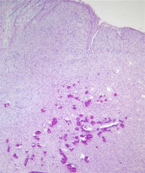 Biopsy Slide Where It Is Possible To Observe Peripheral Ossifying Download Scientific Diagram