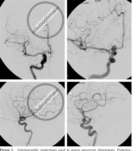 Table 1 From Reporting Standards For Endovascular Repair Of Saccular Intracranial Cerebral