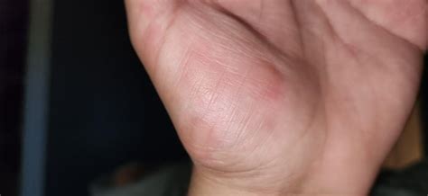 Odd Spots On Left Hand Palm R Dermatologyquestions