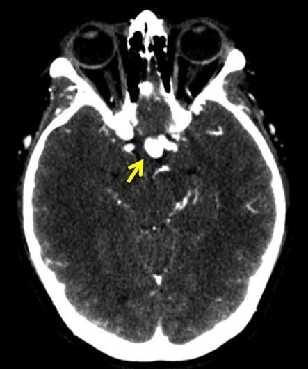 37 Year Old Female With An Unruptured Superior Hypophyseal Aneurysm