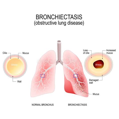 Chronic Obstructive Pulmonary Disease Stock Vector Illustration Of Obstructive Inflammatory