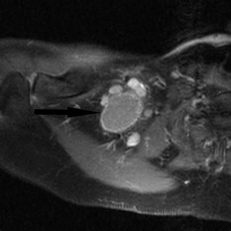 Right Brachial Plexus Mri T1 Weighted Showing The 3 3cm X 2 7cm Mass Download Scientific Diagram