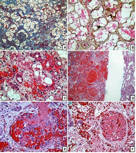 Transmission Electron Microscopy Of Renal Tissue From Patients Download Scientific Diagram