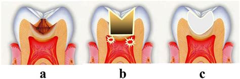 Protection And Reinforcement Of Tooth Structures By Dental Coating