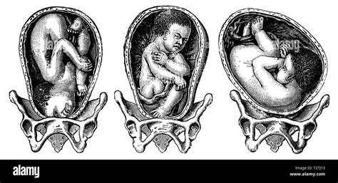 Face Location Breech Transverse Position Shoulder Position From Left Of Embryo In The Womb